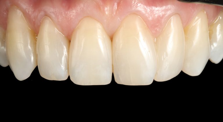 What Causes a Gap in Your Front Teeth? | Smile Stories