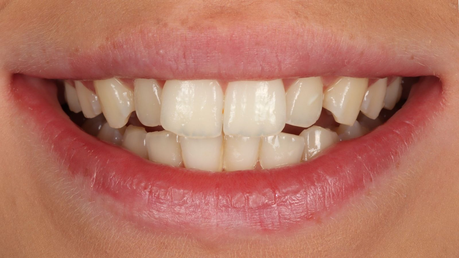 Crowded Front Teeth | Anabel's Smile Story