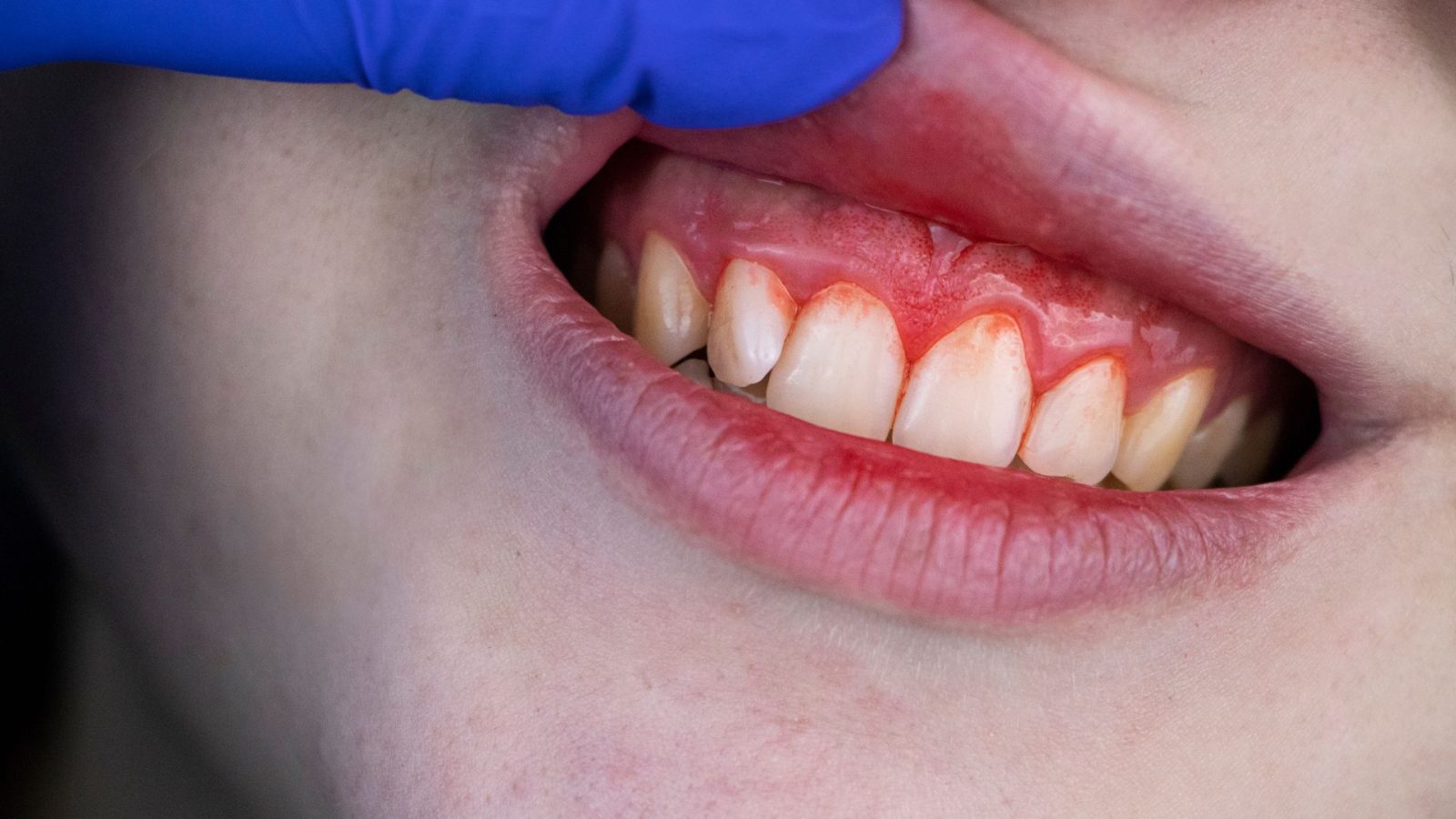 Everything You Need To Know About Bleeding Gums - Smile Stories