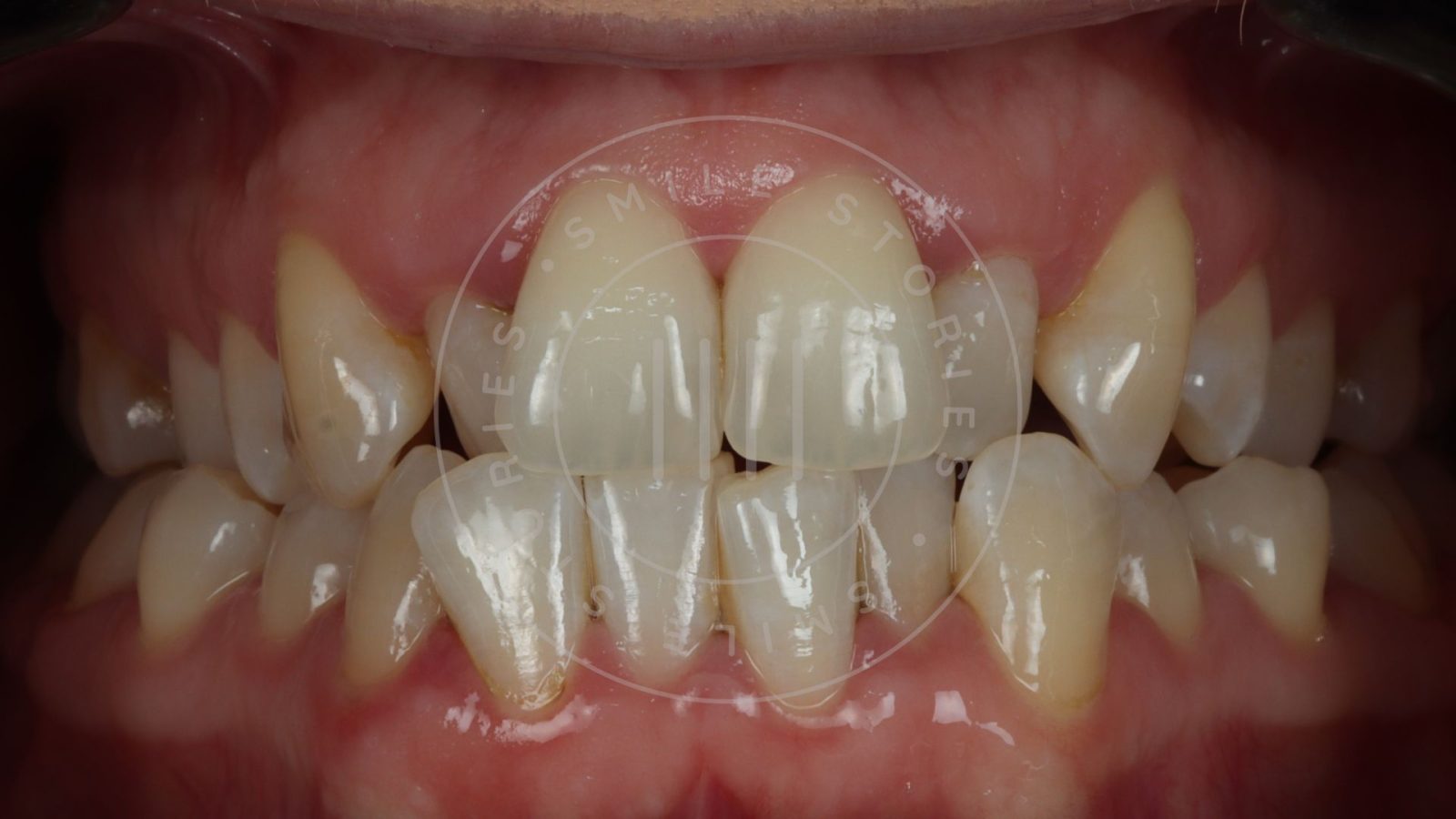 Can Invisalign Fix Crossbite? | Smile Stories