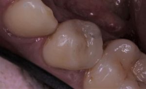 What Is Composite Filling? A Guide | Smile Stories