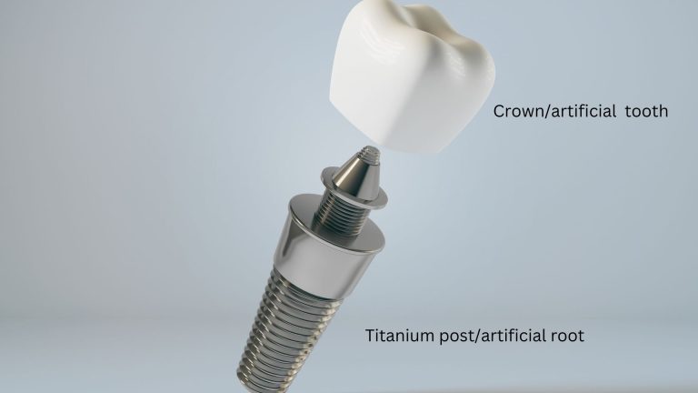 Fixed Vs. Removable Dental Implants - Which is right for you? | Smile ...