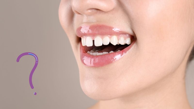 What Causes a Gap in Your Front Teeth? | Smile Stories