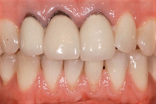 A Guide To Dental Crowns | Smile Stories