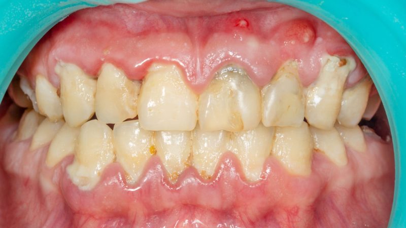 What is Dental Plaque? | Smile Stories